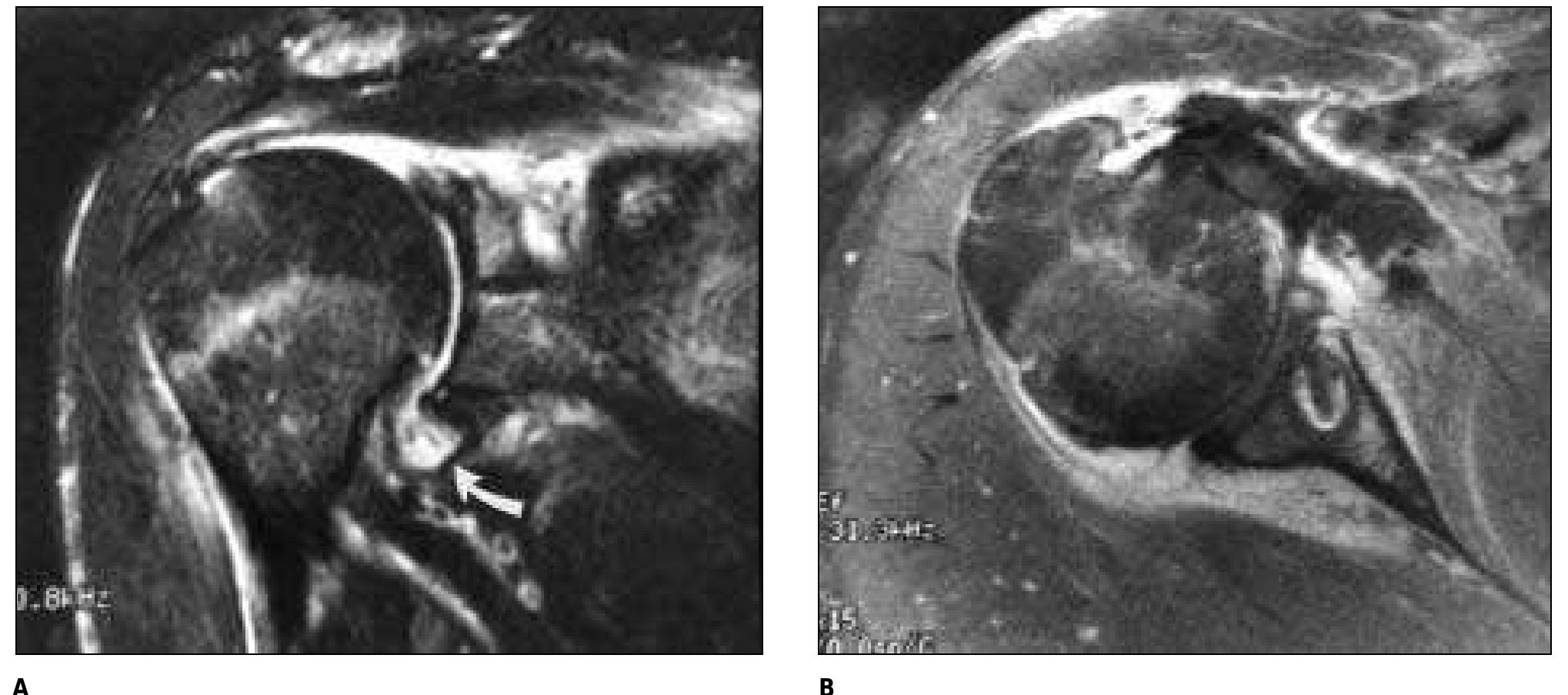 Reactive synovitis and soft-tissue abscess. a 39-year-old