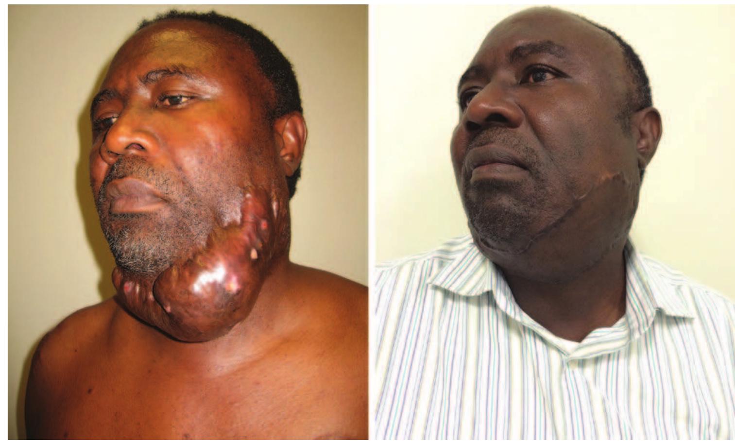 (left) keloid scarring in an african patient after minor