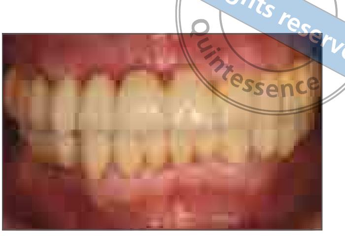 Maxillary porcelain fused to metal prostheses when the