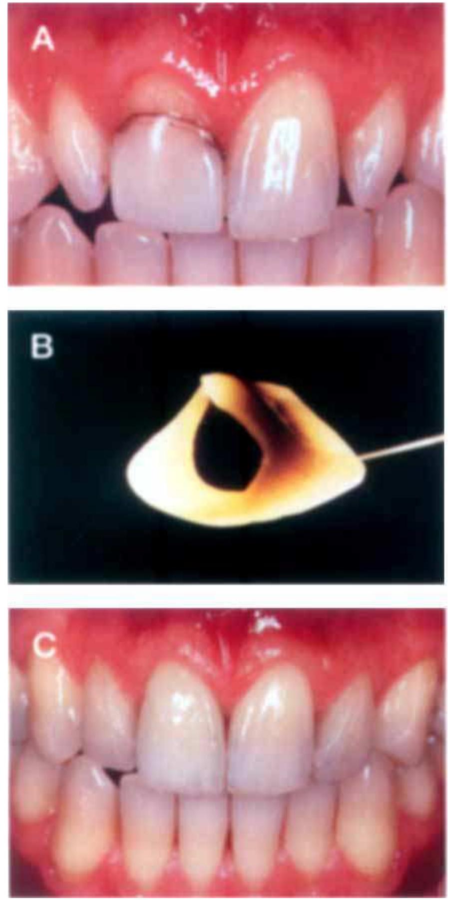 The patient exhibits peg-shaped maxillary lat- eral incisors