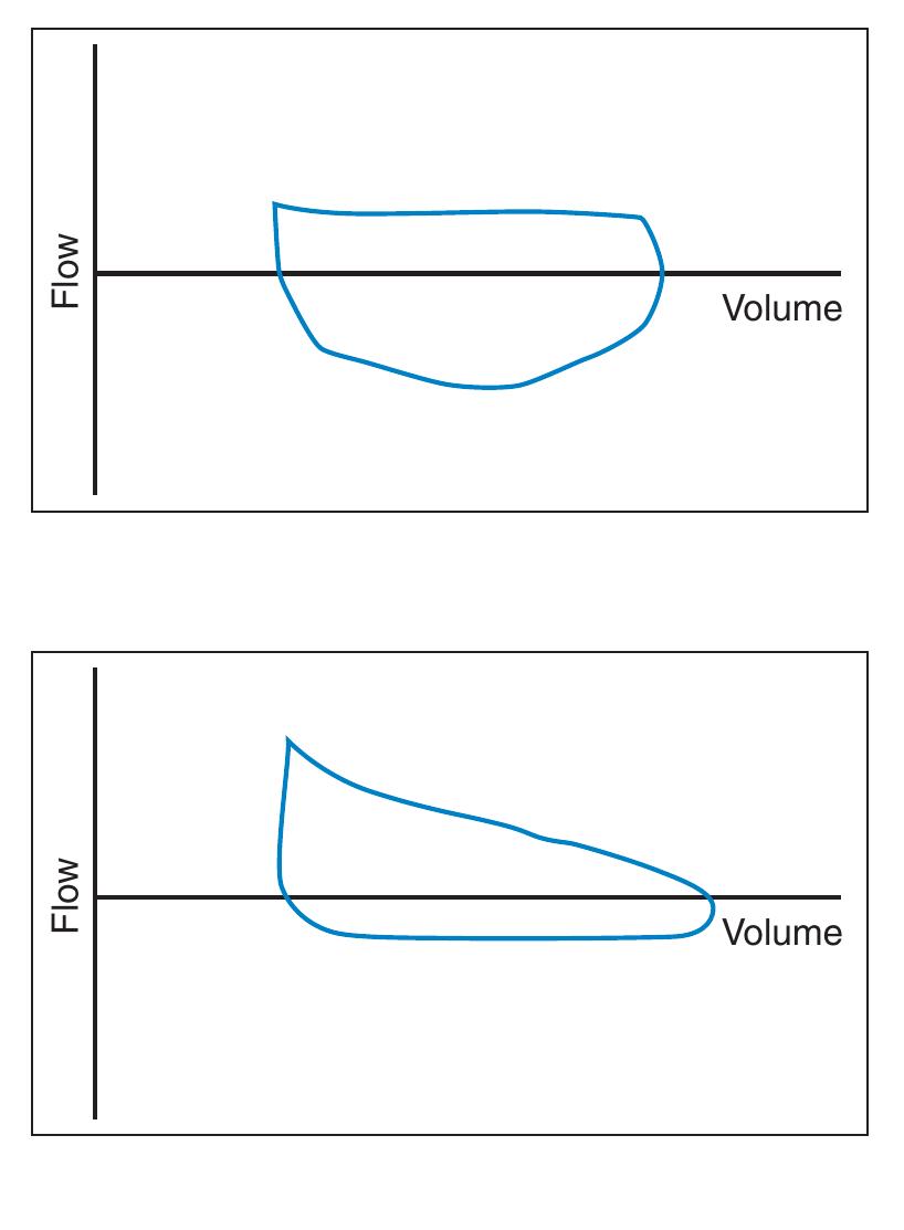 Differential diagnosis of rigid large-airway obstruction the