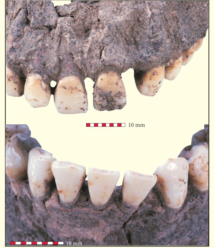 30 upper: the anterior maxillary teeth of burial 4. the left
