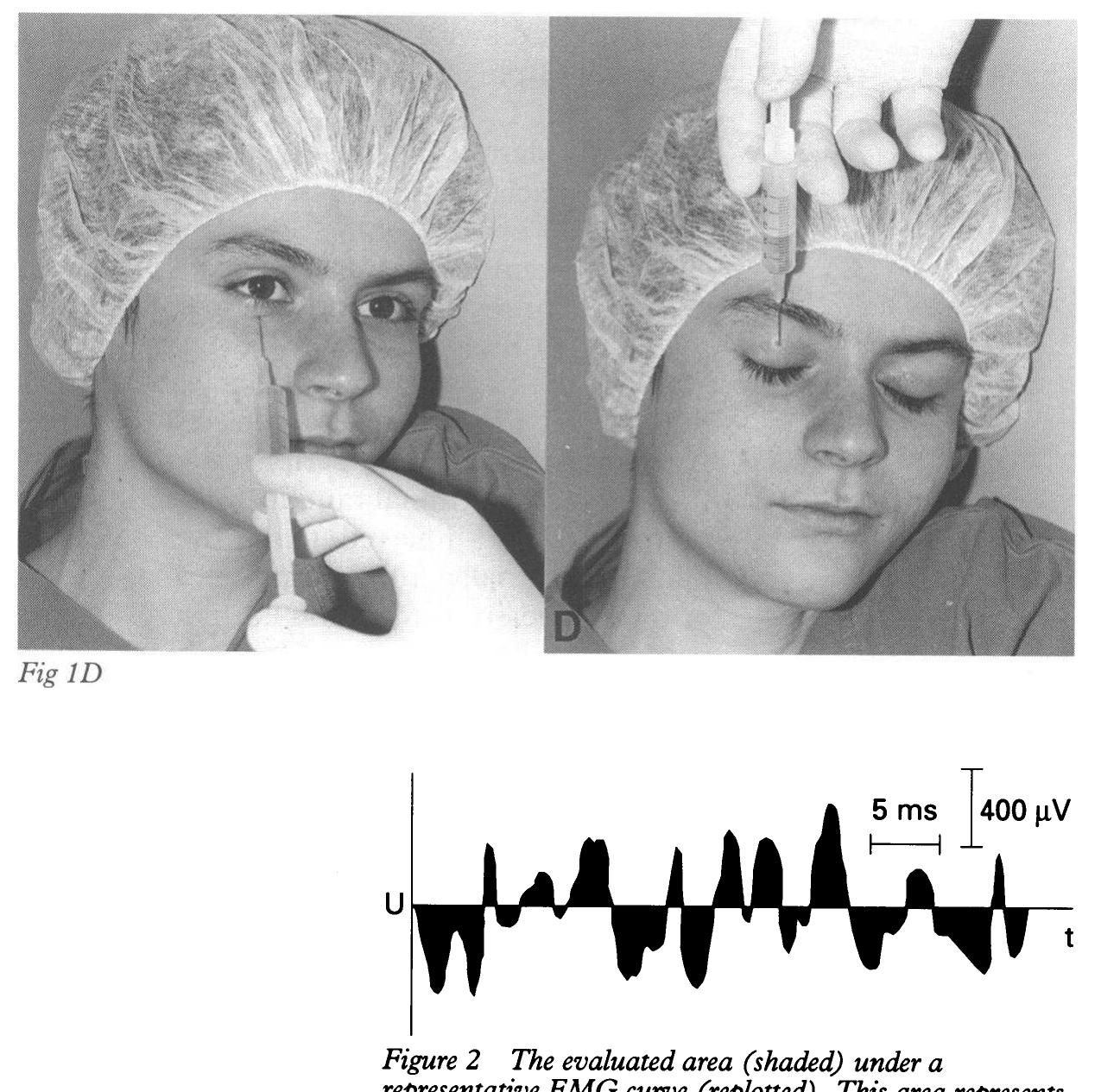 Figure 3 - Techniques of facial nerve block