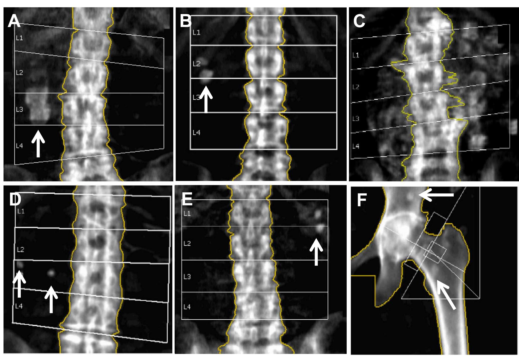 Illustration of six examples of calcification on dexa