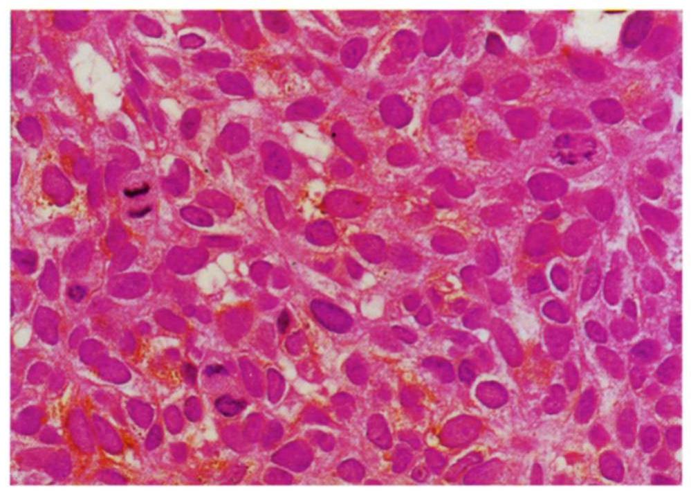 = mitotically active, small, epithelioid cells with nuclear