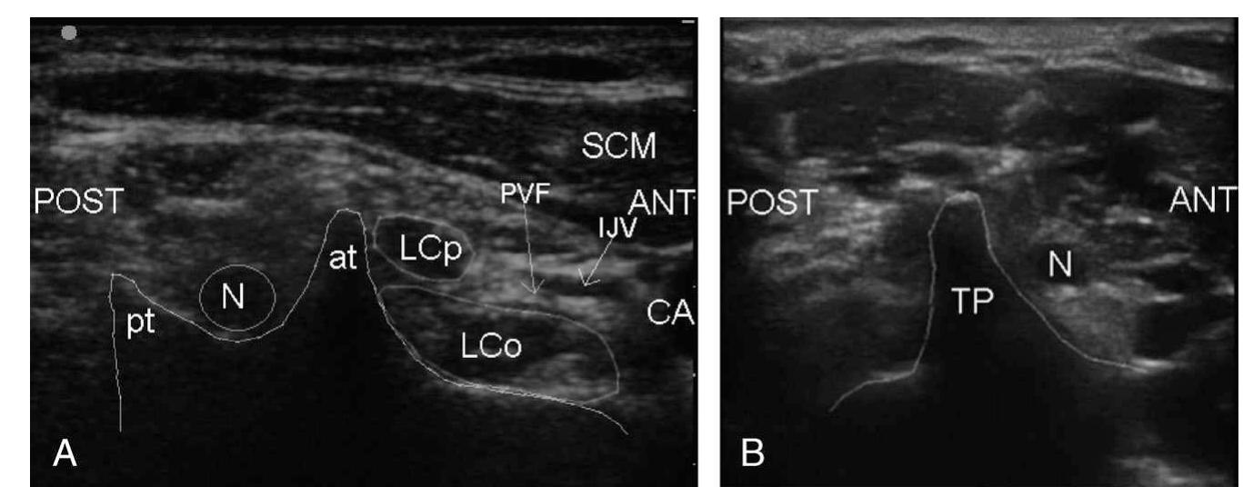 Short-axis ultrasonography of the neck. a, c6 level. at