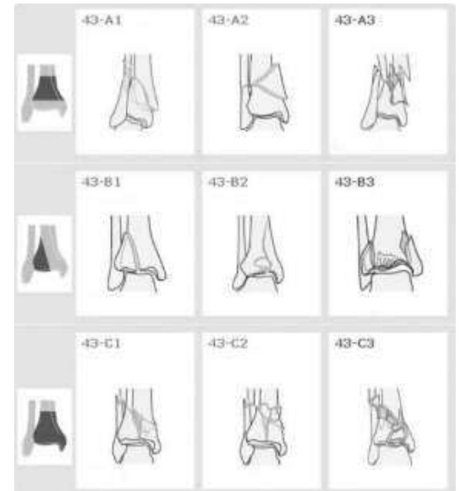 Ao classification of distal tibia fractures table 1: