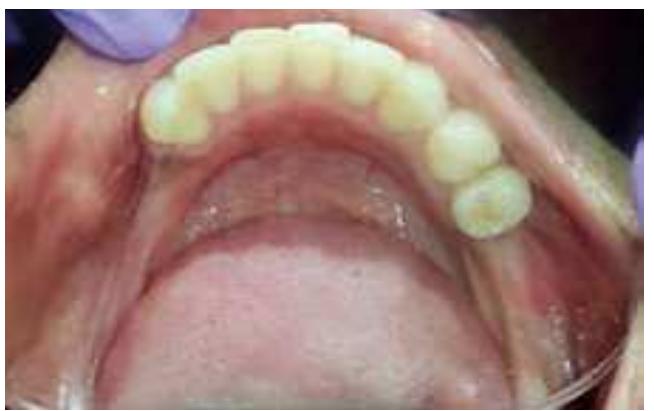 Pre-operative photograph of mandibular arch