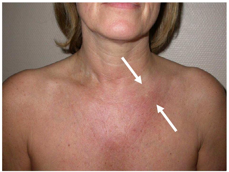 Swelling of the left clavicular fossa several days after
