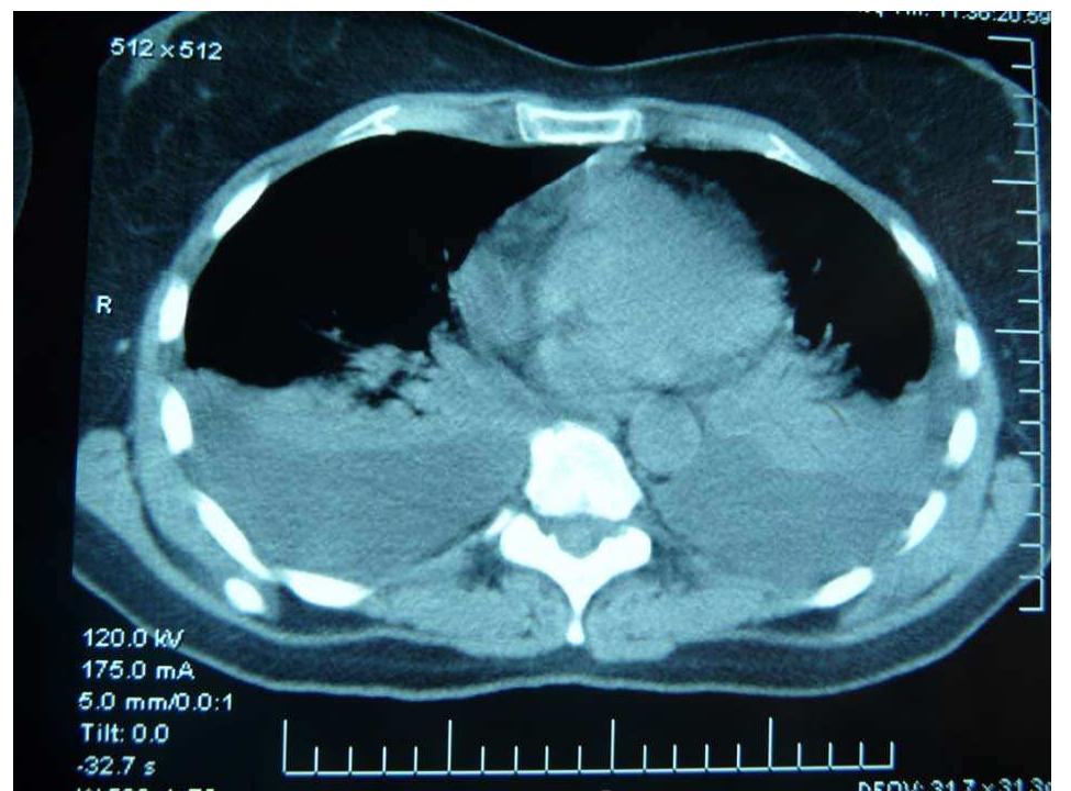 Ct scan confirms the pleural effusions seen on prior chest