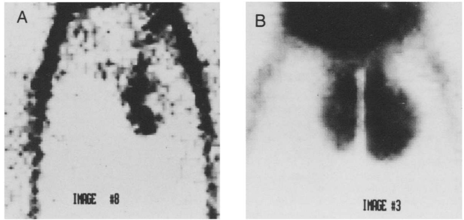 Epididymo-orchitis: medial epididymis. images of a