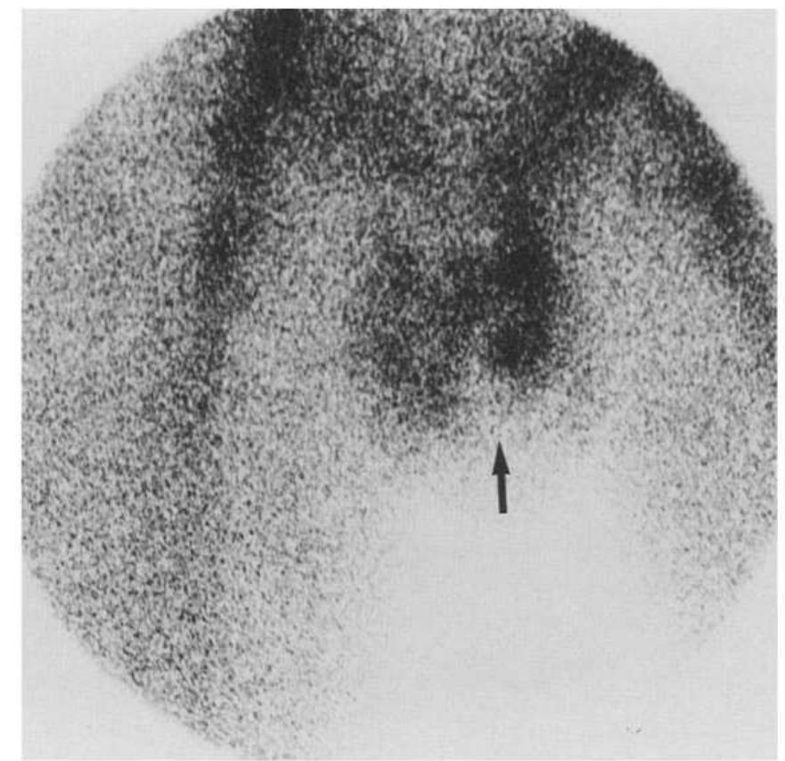 Testicular infarct following appendix testis torsion. images