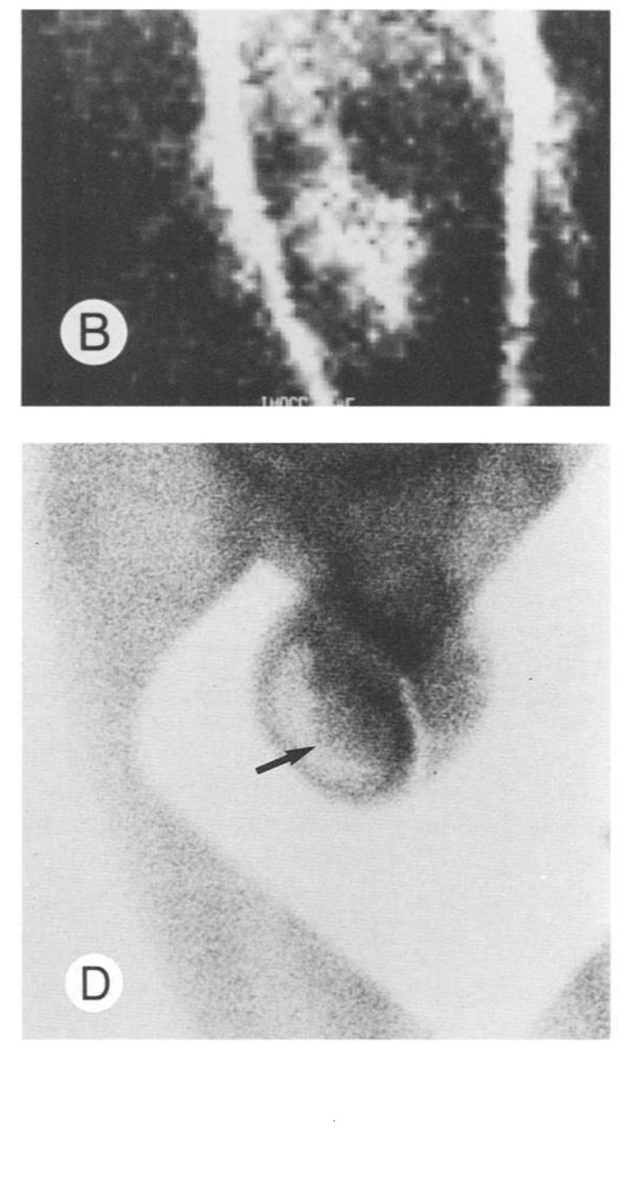 Epididymitis and hydrocoele. images from a 66-year-old man