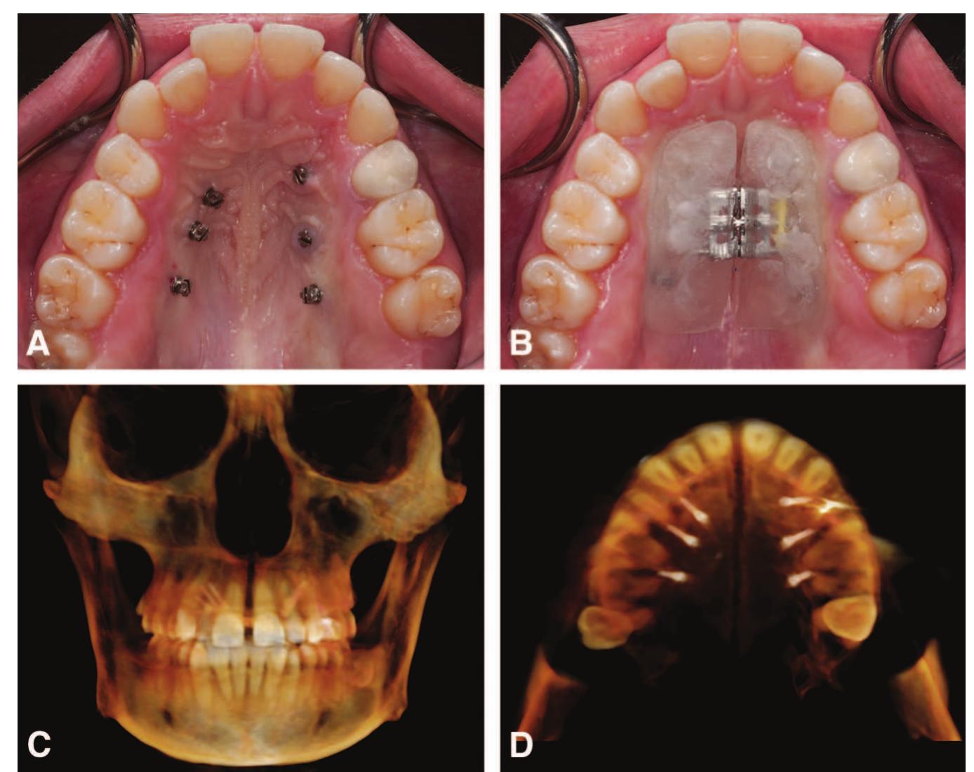 A 25-year-old female with history of orthodontic treatment.