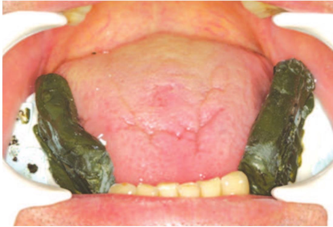 The mucostatic impression with the occlusal rims in place.