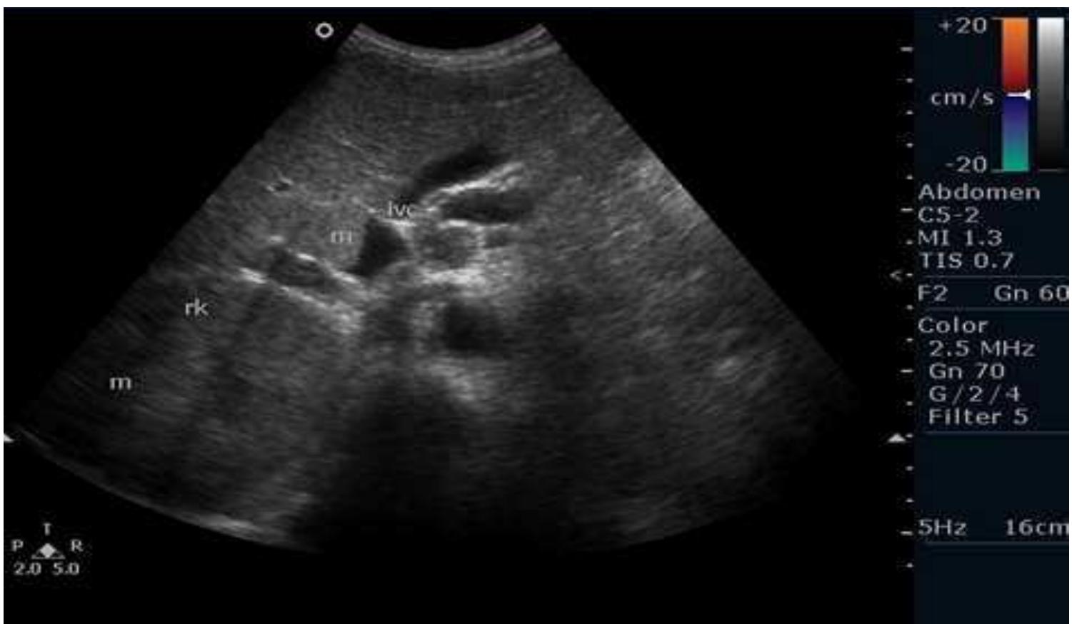 - ultrasound image showing heterogenous well-defined mass in
