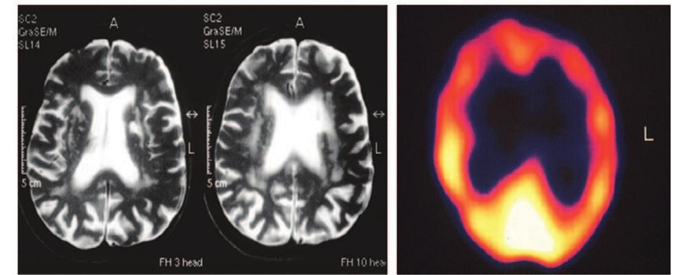 Vascular dementia. axial mri showing severe deep white