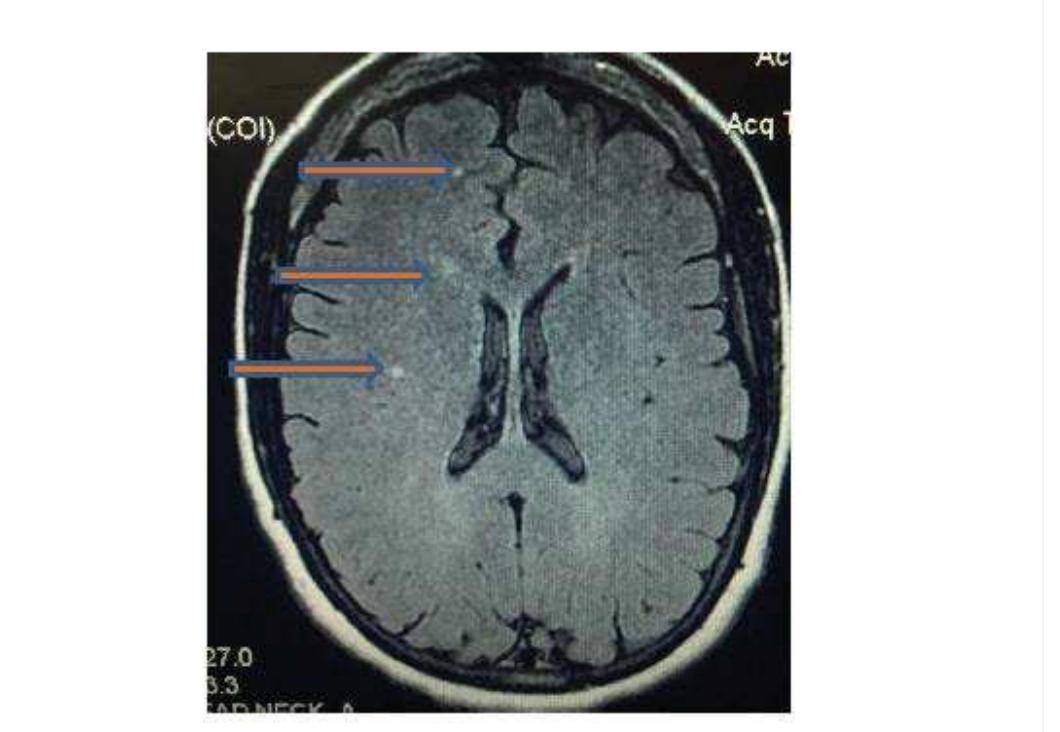 This is a mri of the brain of patient 1. it shows infarcts