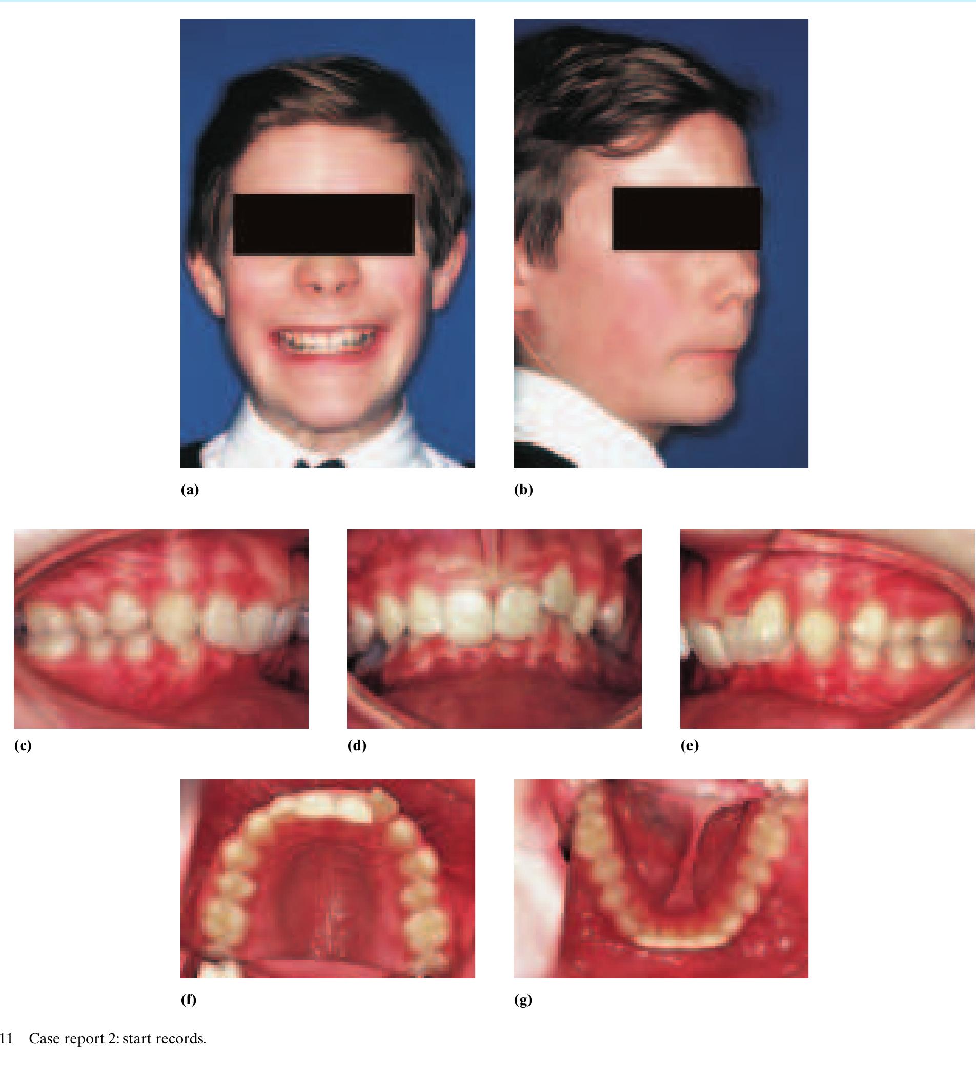 Fic. 12 case report 2: modified twin blocks.