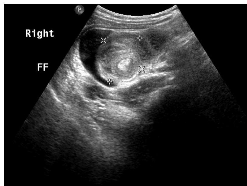 The typical appearance of intussusception. note the