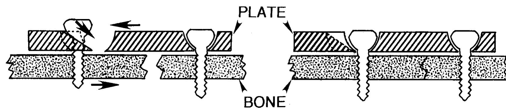 4 principle of a dynamic compression plate for fracture