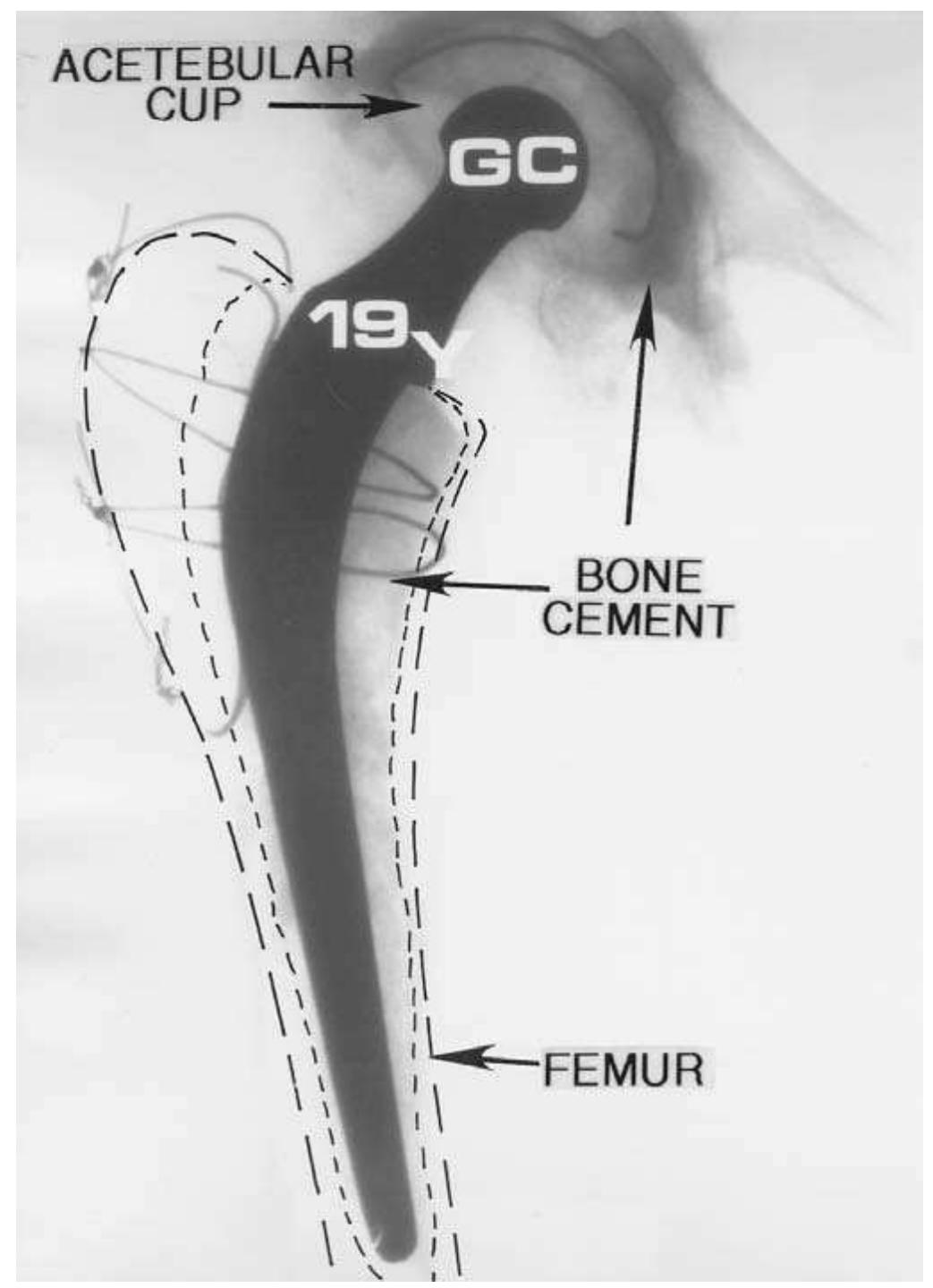 8(a) radiograph of bone cement fixed charnley hip joint