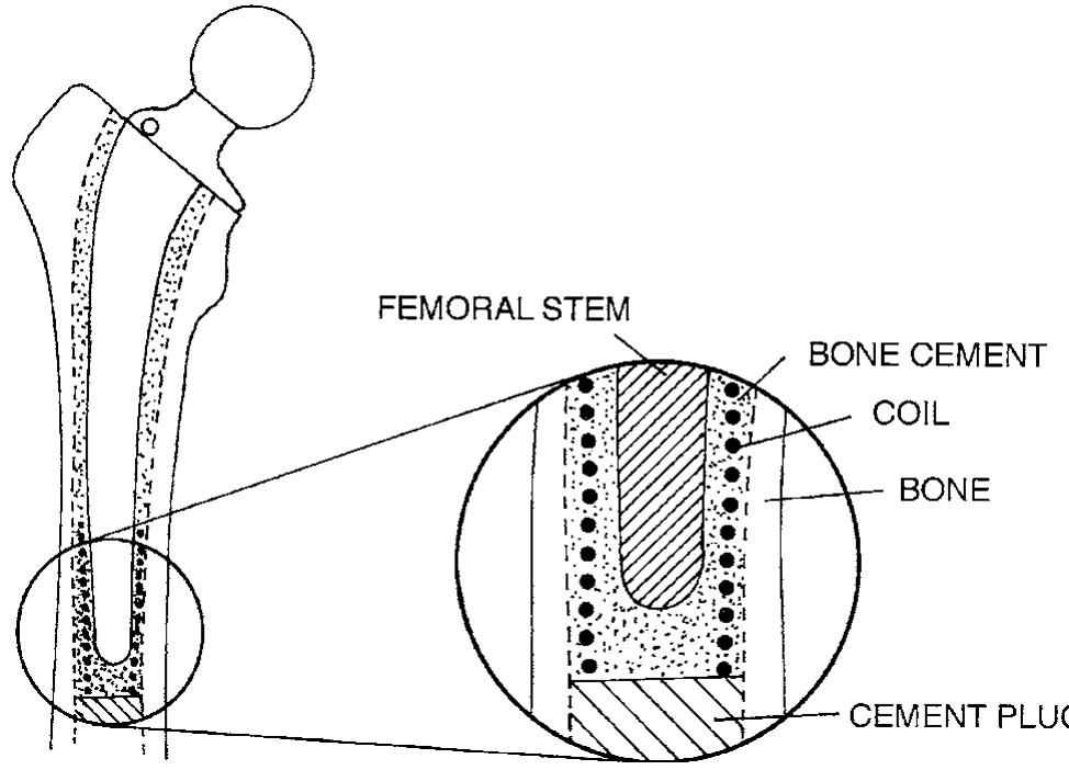 4 illustration of the reinforcement of the bone cement