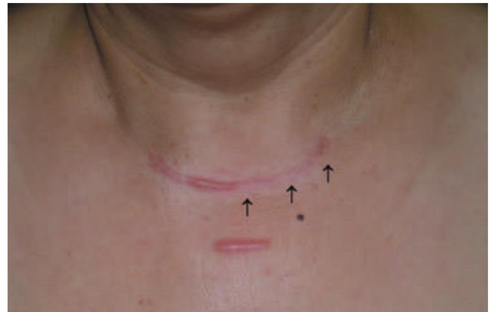 Reduction of redness, thickness, scar surface texture, size,