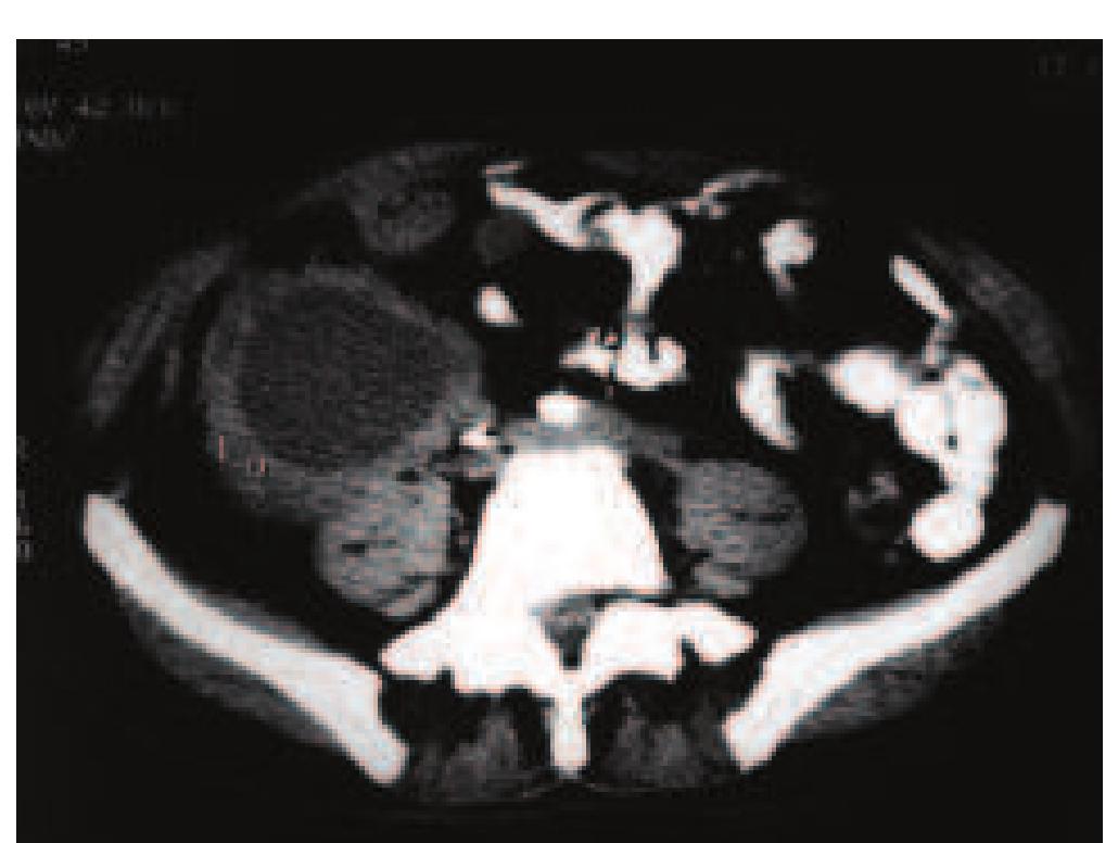 Ura 1. tac de paciente con absceso periapendicular forma do