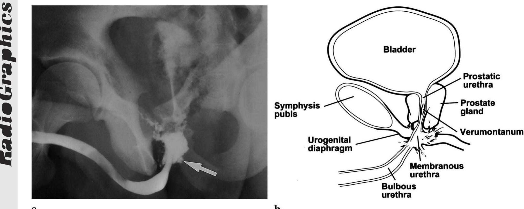 Posterior urethral rupture extending through the urogenital