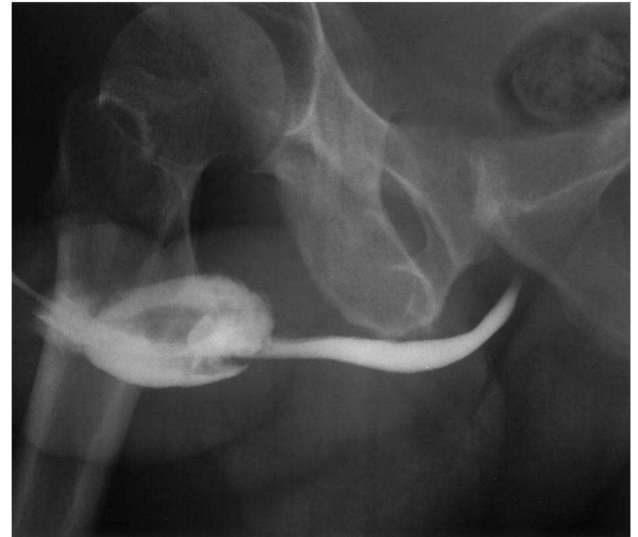 Urethral injury in penile fracture. retro- grade urethrogram