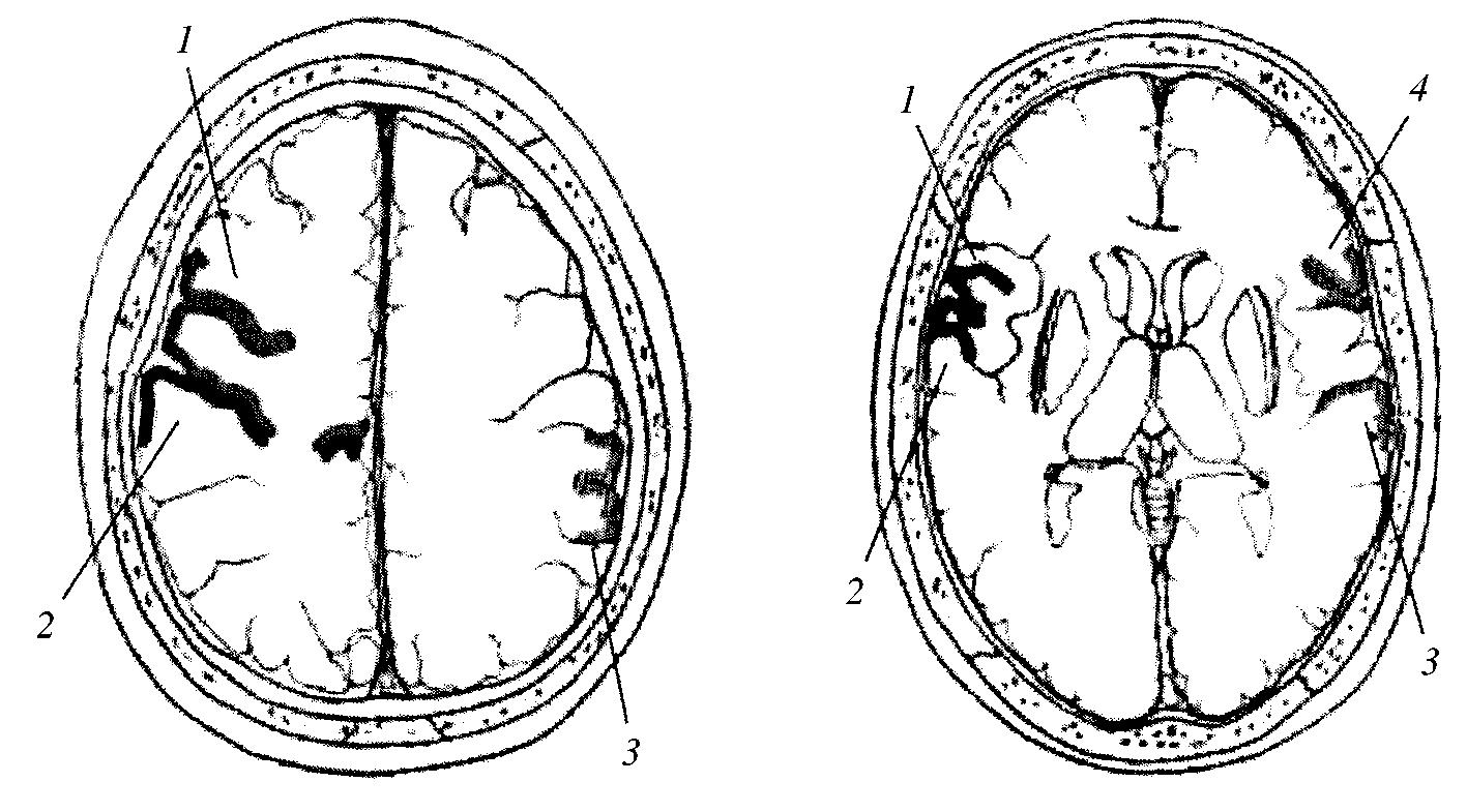 Figure 1 - from Localization of the Motor and Speech Zones