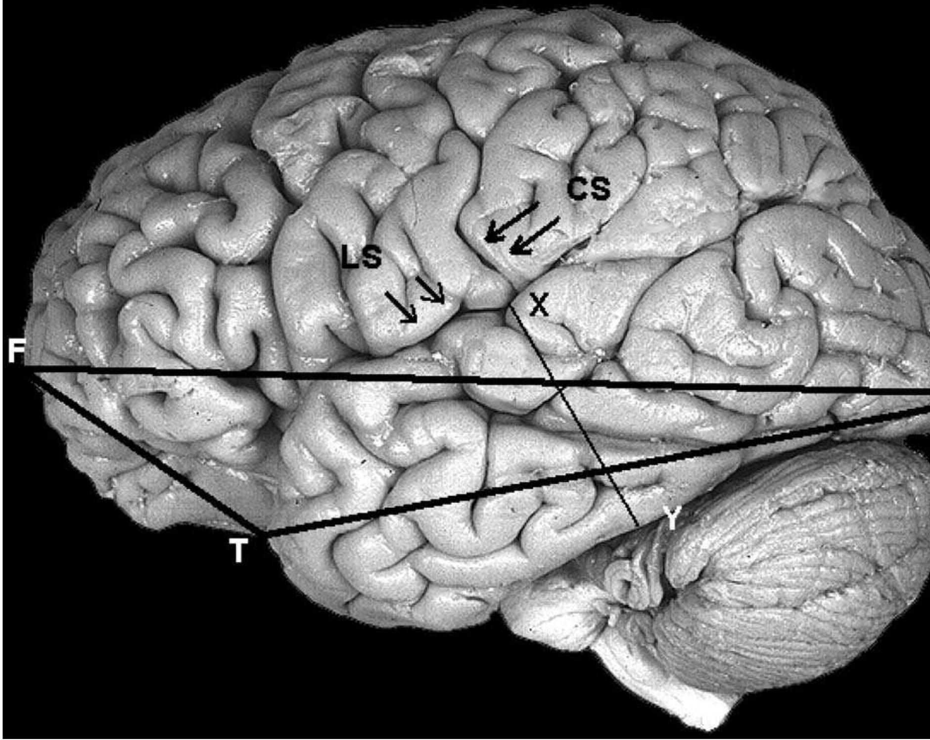 Linear measurements of the cerebrum from the lateral aspect.