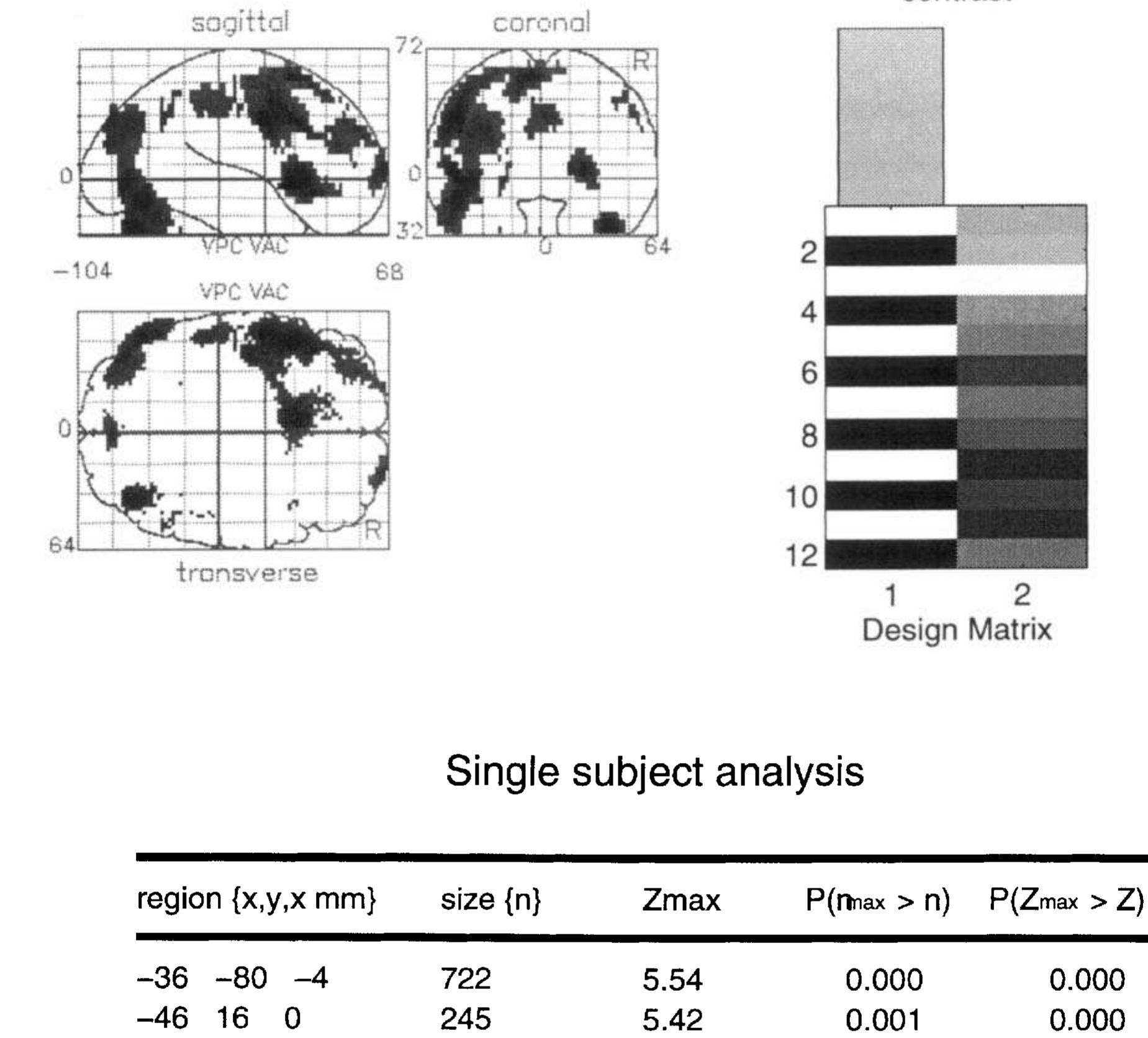 Figure 1 Statistical Parametric Maps In Functional