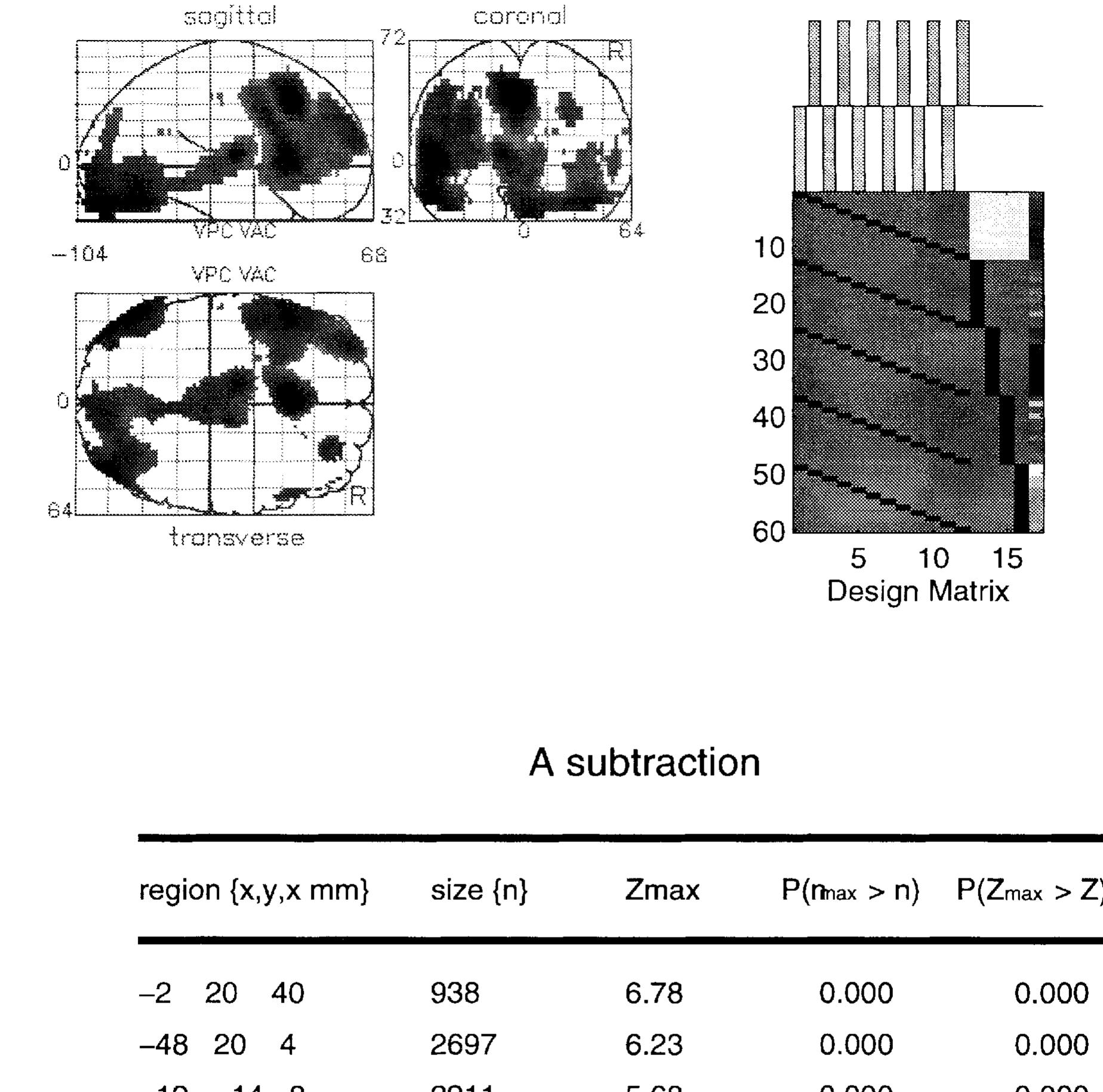 Figure 3 Statistical Parametric Maps In Functional