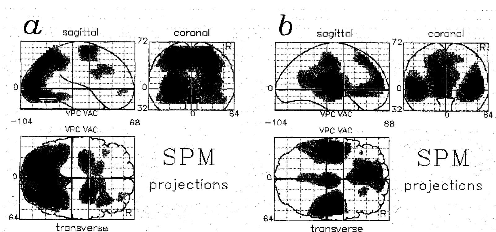 Statistical parametric maps (spms) of the comparison of the