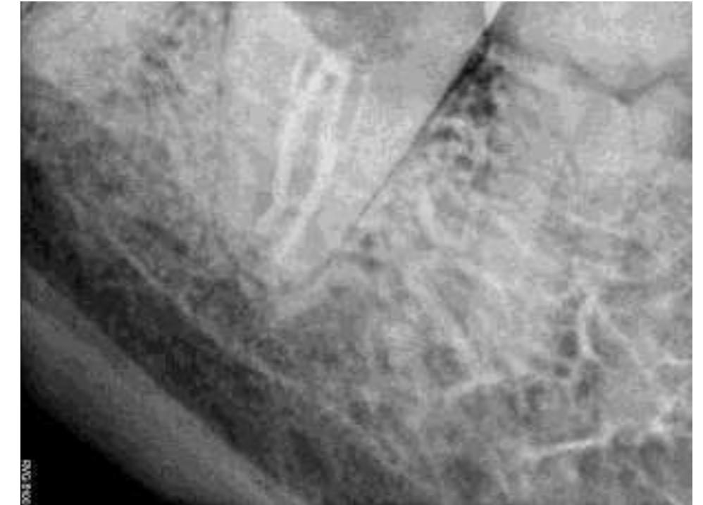 - pre-operative radiograph the tooth was temporized using