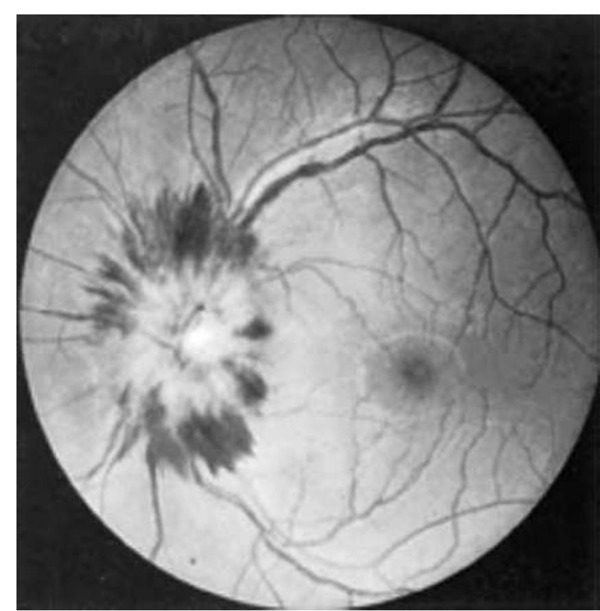 -1 acute papilledema. the optic disk is swollen, and