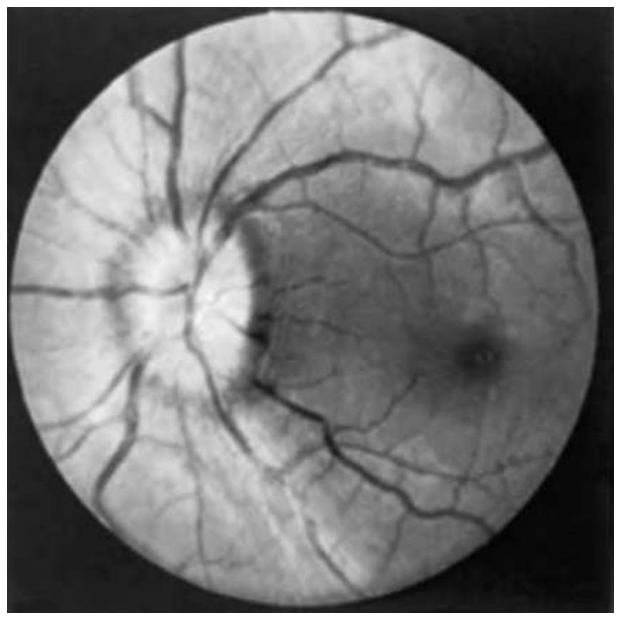 -2 established papilledema. the optic disk is elevated, and