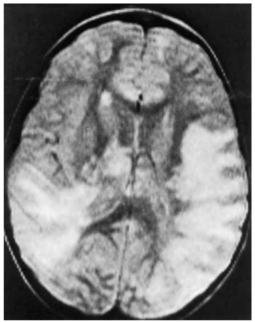 -1 krabbe disease. mri reveals extensive demyelination of