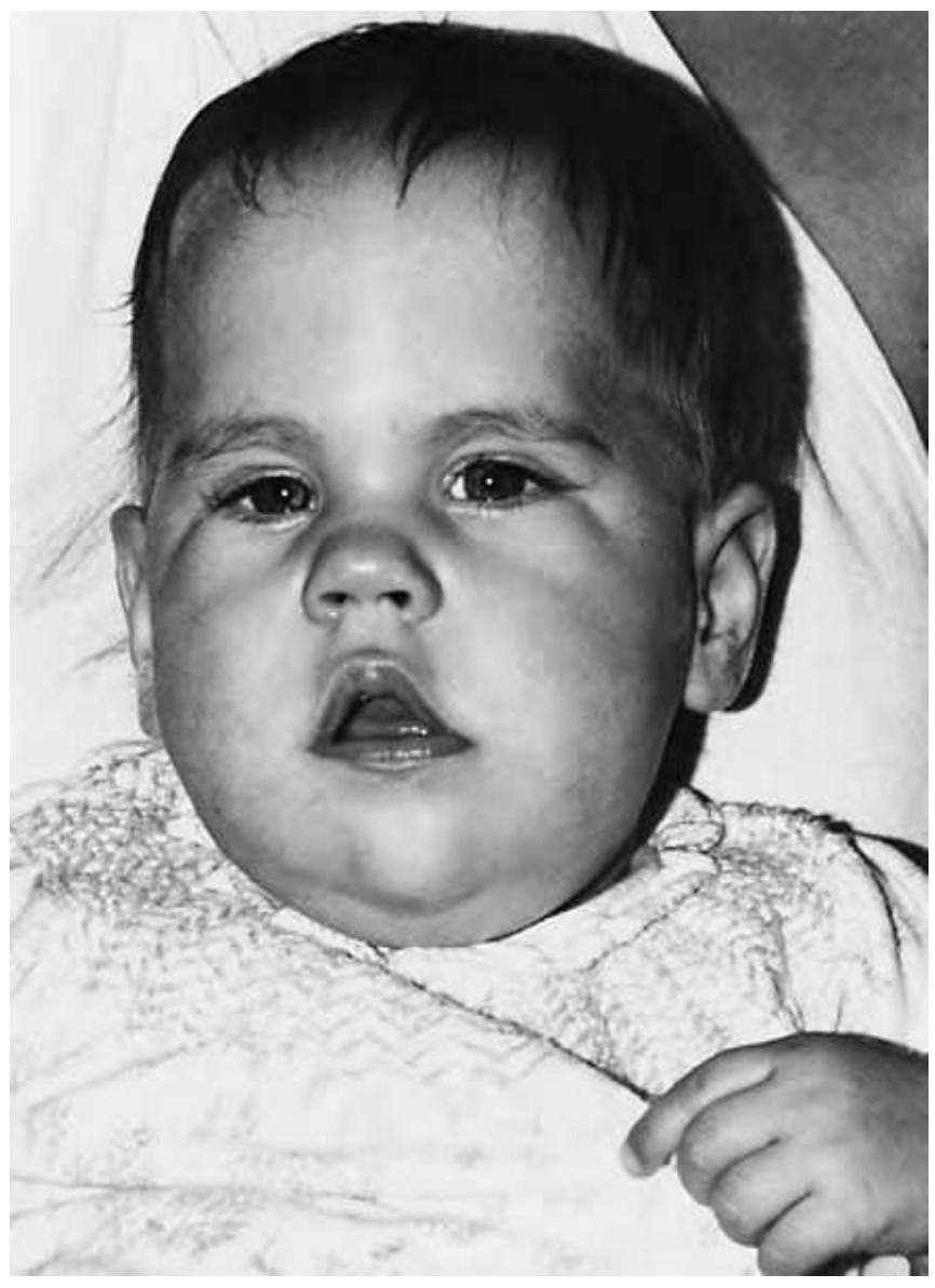 -8 infantile myotonic dystrophy. the mouth has an inverted v