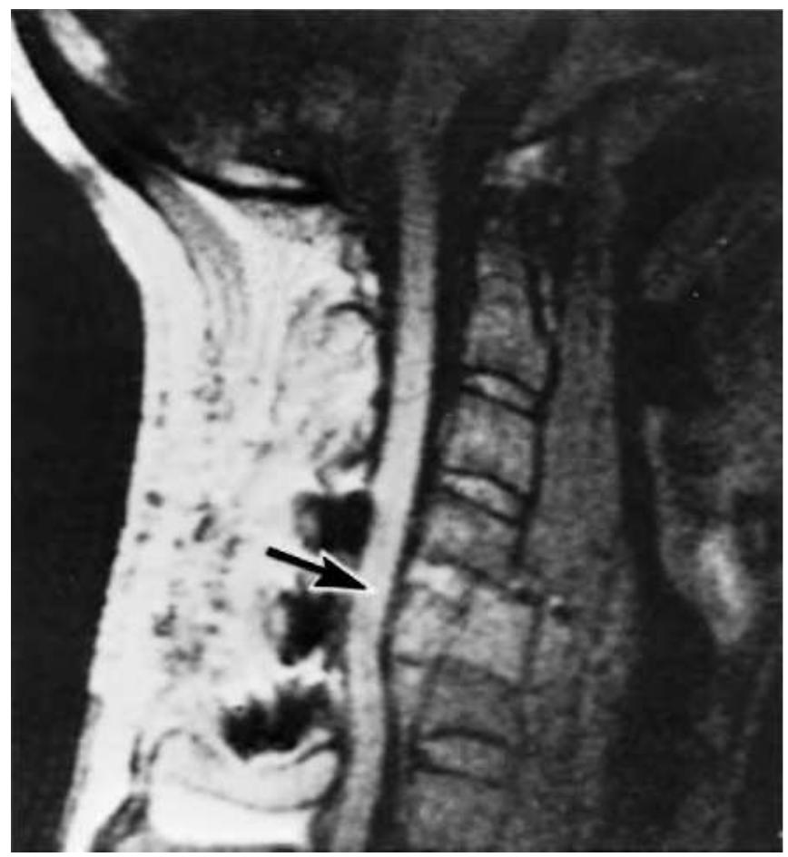 -4 fracture-dislocation. c4 is dislocated on c5, causing