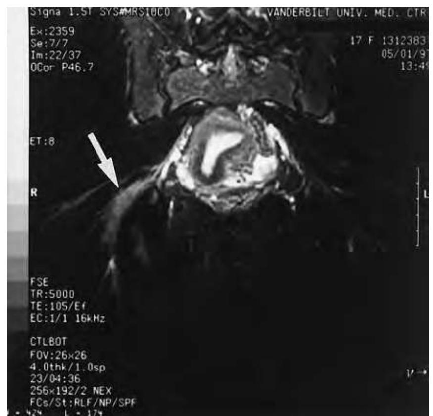 -1 neurofibroma of the lumbar plexus. magnetic resonance