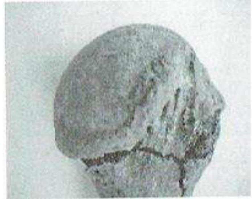 Anomalous morphology of the left humeral head of the