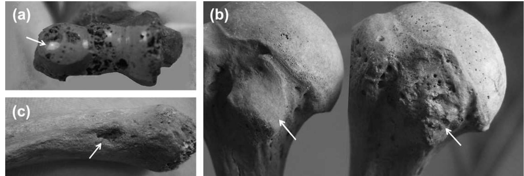 3 (a) osteoarthritis of the distal humeral joint with