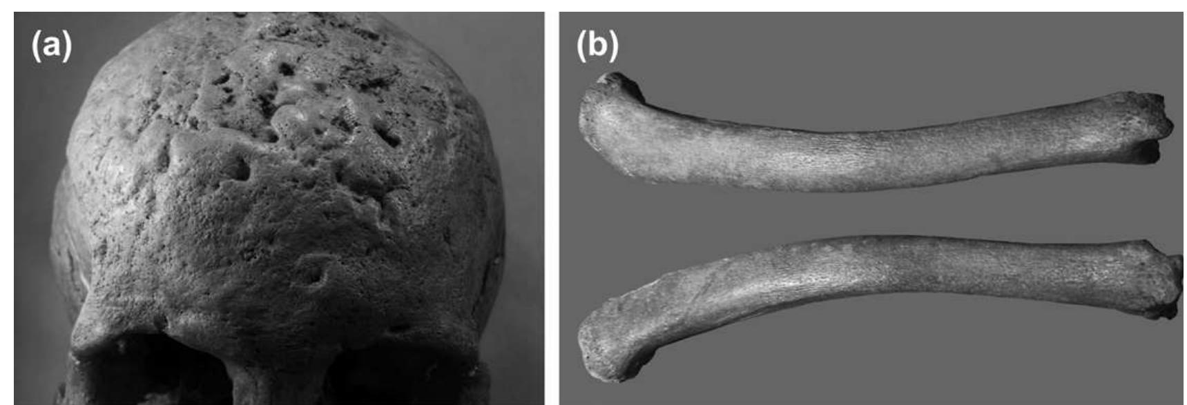 4 (a) pathognomonic caries sicca of treponemal disease. (b)