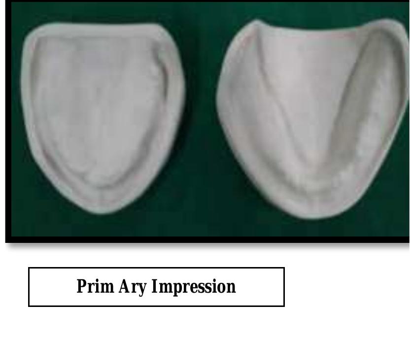 Figure 2 - THE SPLIT MANDIBULAR COMPLETE DENTURE – TECHNIQUE