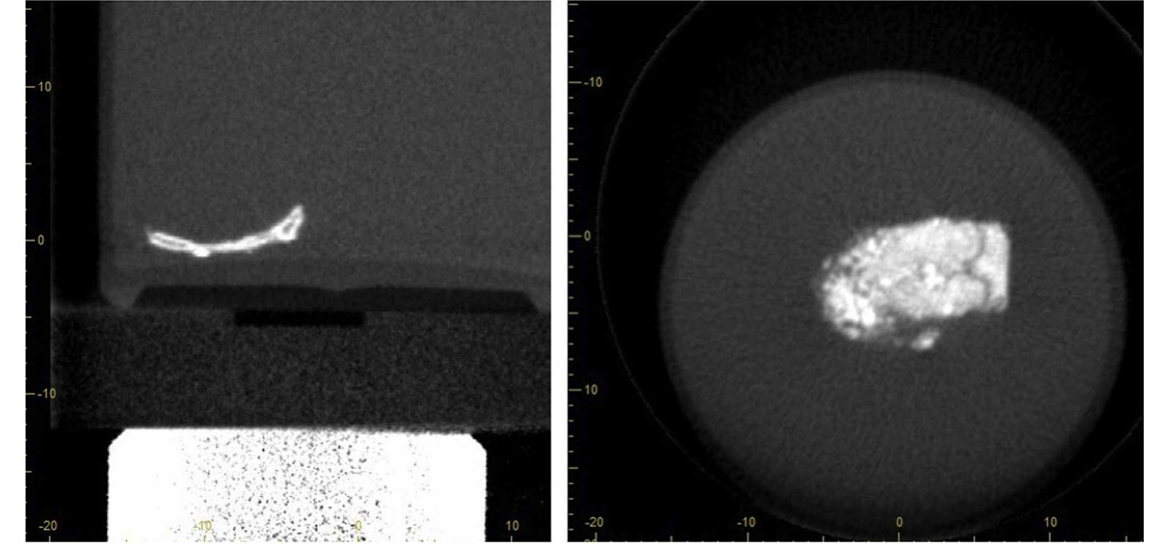 A micro-ct sample, xenogenic, bovine derived bone substitute