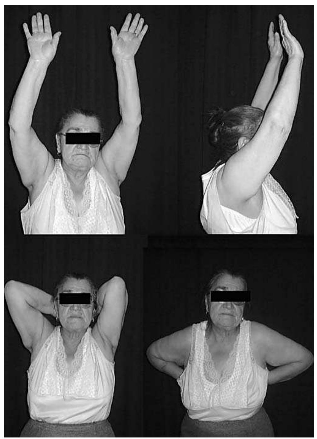 Pictures showing range of motion of both shoulder joints 3