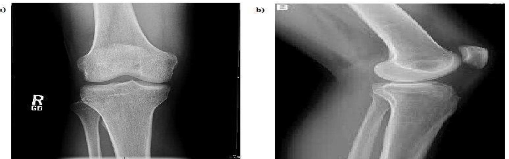 A) sample anterio-posterior view b) sample lateral view
